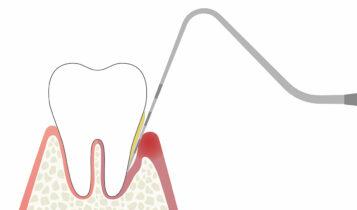 Perio Update - Decisions in Dentistry