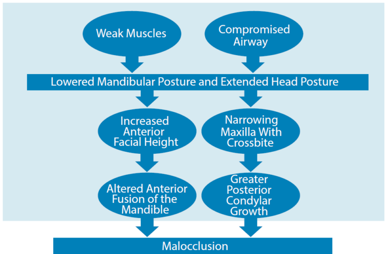 The Role of Orofacial Myofunctional Disorders in Malocclusion ...
