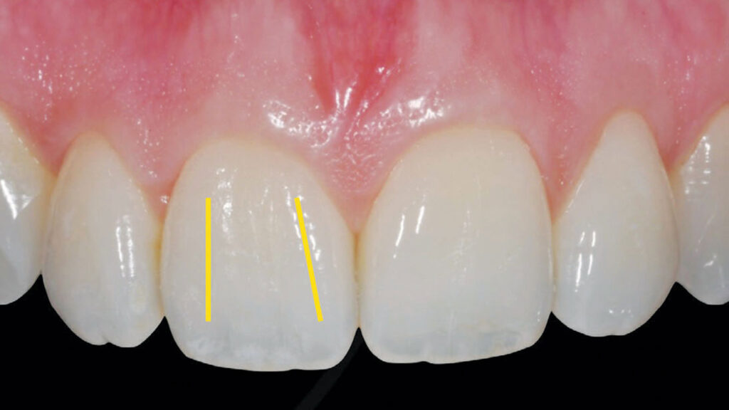 Properly Developing Line Angles - Decisions in Dentistry