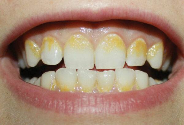 The Importance of Biofilm Removal - Decisions in Dentistry