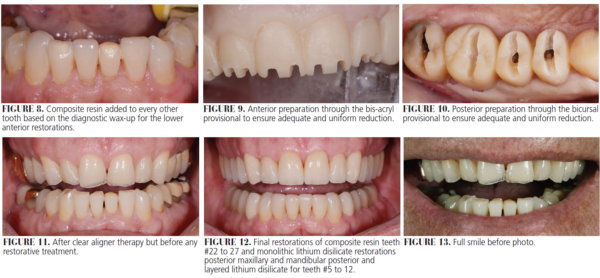 Achieve Positive Outcomes in Full Mouth Esthetic and Functional ...