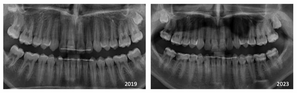 Breaking Down Dental Caries - Decisions in Dentistry