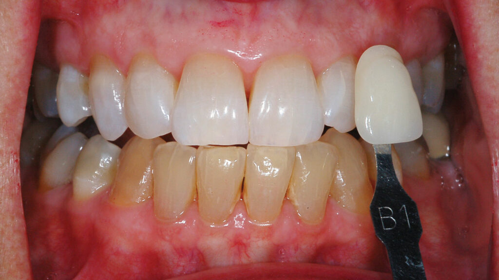 Providing Patient-Focused Whitening Approaches - Decisions in Dentistry