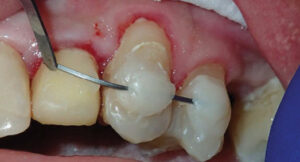 Improve Restorability With Orthodontic Extrusion - Decisions in Dentistry