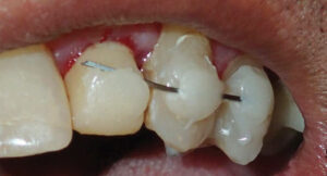 Improve Restorability With Orthodontic Extrusion - Decisions in Dentistry