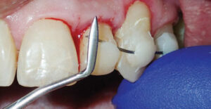 Improve Restorability With Orthodontic Extrusion - Decisions in Dentistry