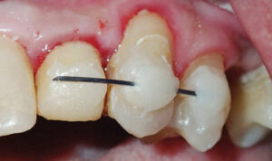 Improve Restorability With Orthodontic Extrusion - Decisions in Dentistry