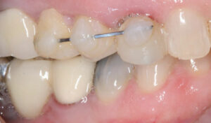 Improve Restorability With Orthodontic Extrusion - Decisions in Dentistry