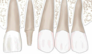 Improve Restorability With Orthodontic Extrusion - Decisions in Dentistry