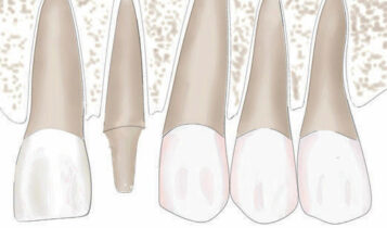Improve Restorability With Orthodontic Extrusion - Decisions in Dentistry