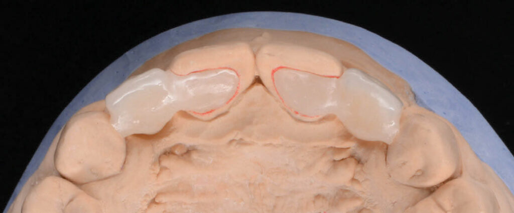 A Dark Horse of Restorative Dentistry - Decisions in Dentistry