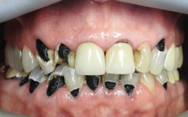 Beauty in Simplicity - Decisions in Dentistry