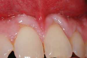 Minimally Invasive Treatment of Gingival Clefts - Decisions in Dentistry