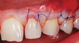 Minimally Invasive Treatment of Gingival Clefts - Decisions in Dentistry