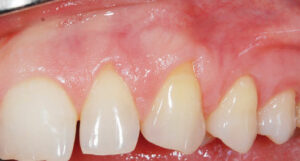 Minimally Invasive Treatment of Gingival Clefts - Decisions in Dentistry