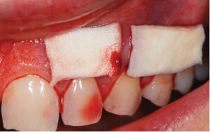 Minimally Invasive Treatment of Gingival Clefts - Decisions in Dentistry