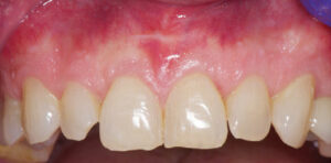 Minimally Invasive Treatment of Gingival Clefts - Decisions in Dentistry