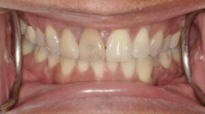 Effectiveness of Bleaching Agents Used in the Walking Bleach Technique ...