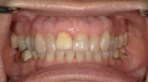 Effectiveness of Bleaching Agents Used in the Walking Bleach Technique ...