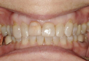 Effectiveness of Bleaching Agents Used in the Walking Bleach Technique ...