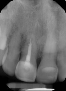 Effectiveness of Bleaching Agents Used in the Walking Bleach Technique ...