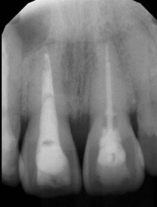 Effectiveness of Bleaching Agents Used in the Walking Bleach Technique ...