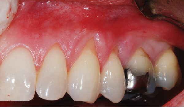Minimally Invasive Treatment of Gingival Clefts - Decisions in Dentistry