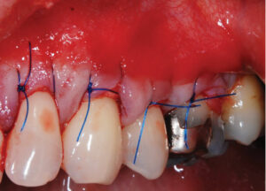 Minimally Invasive Treatment of Gingival Clefts - Decisions in Dentistry