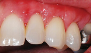 Minimally Invasive Treatment of Gingival Clefts - Decisions in Dentistry