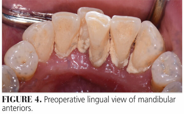 Strategic Considerations for the Periodontally Questionable Tooth ...