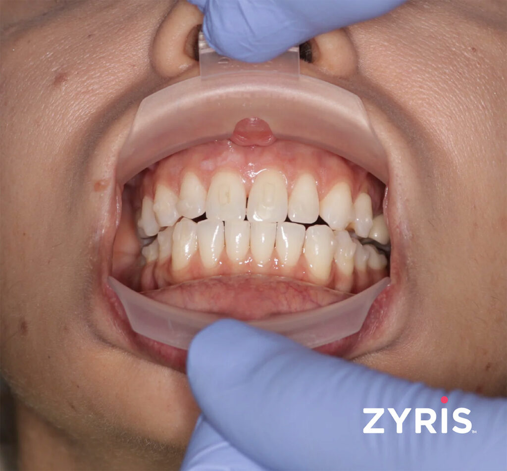 Introducing the Zyris Retractor - Decisions in Dentistry