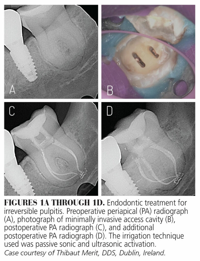 New Paradigms in Endodontic Irrigation - Decisions in Dentistry