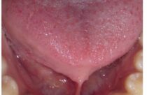 Revealing the Truth About Chlorhexidine, and a Better Alternative ...