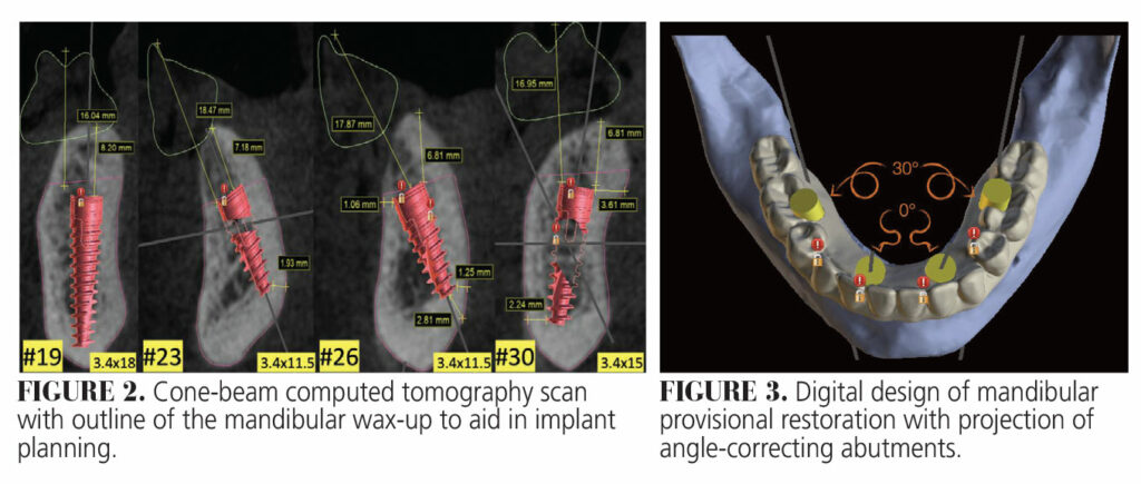 CAD/CAM-Driven Full-Arch Restorations - Decisions in Dentistry