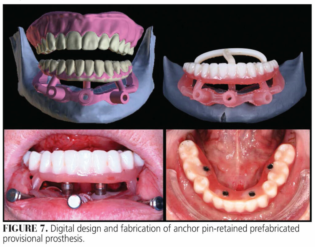 CAD/CAM-Driven Full-Arch Restorations - Decisions in Dentistry