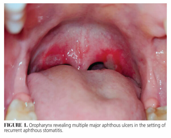 Common Oral Lesions in the Dental Setting - Decisions in Dentistry