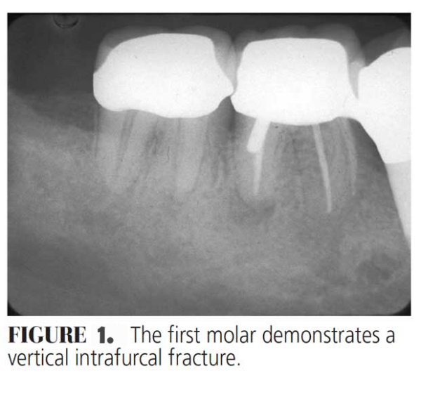 Immediate vs Delayed Implant Placement - Decisions in Dentistry