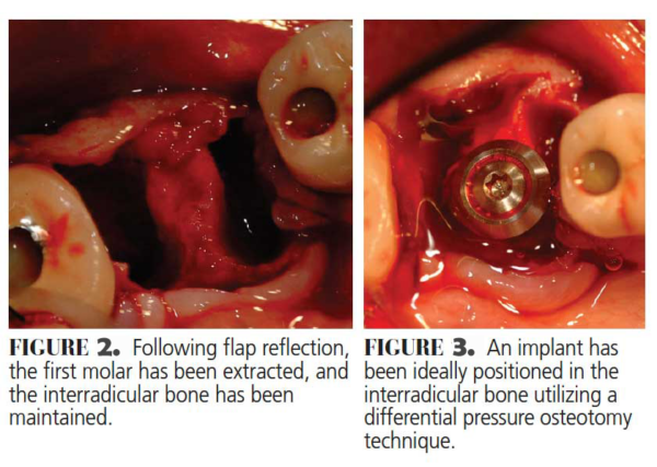 Immediate vs Delayed Implant Placement - Decisions in Dentistry