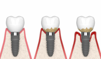 Perio Update - Decisions in Dentistry