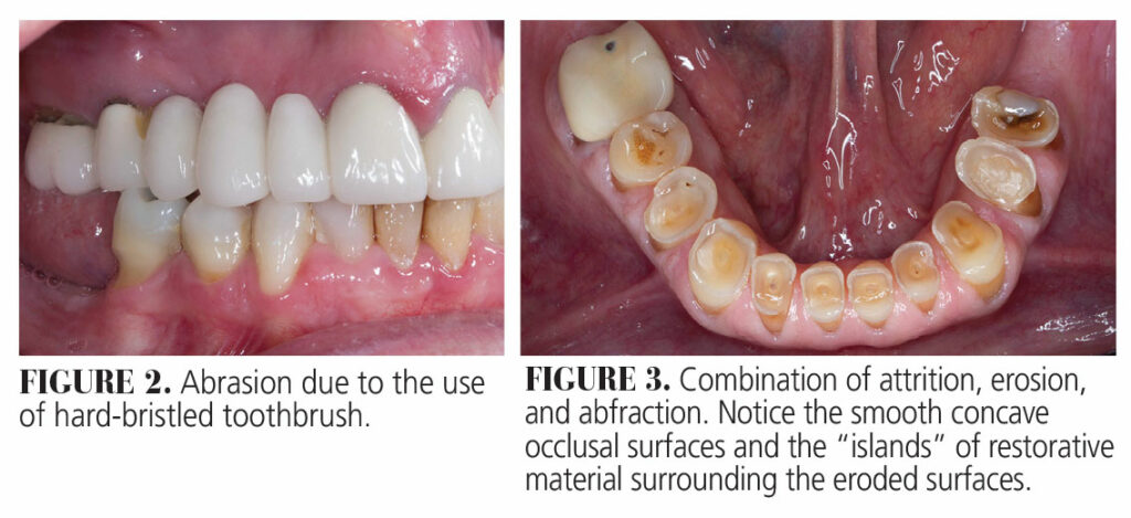 Unraveling the Impact of Tooth Wear on Oral Health - Decisions in Dentistry
