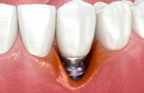 Mastering Immediate Implant Placement: The 10 Keys to Long-Term Success ...