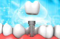 Mastering Immediate Implant Placement: The 10 Keys to Long-Term Success ...