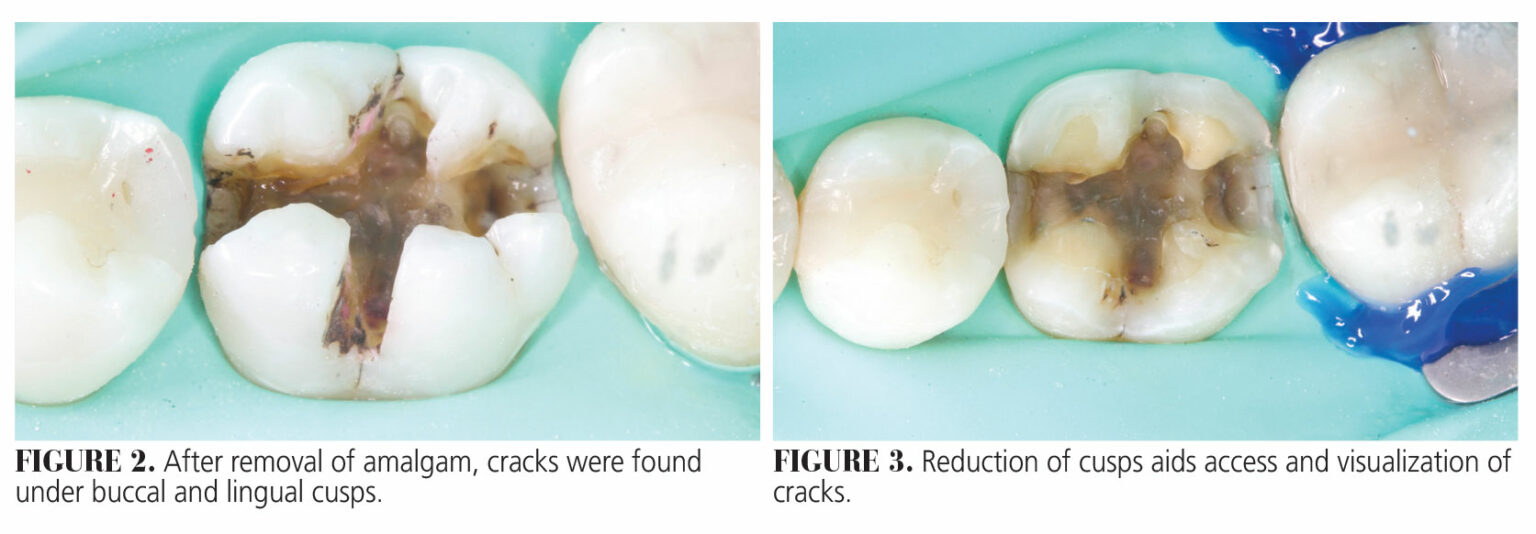 Preserve Natural Teeth With Biomimetic Dentistry - Decisions in Dentistry