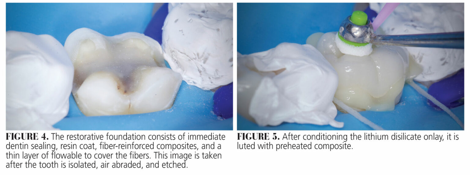 Preserve Natural Teeth With Biomimetic Dentistry - Decisions in Dentistry