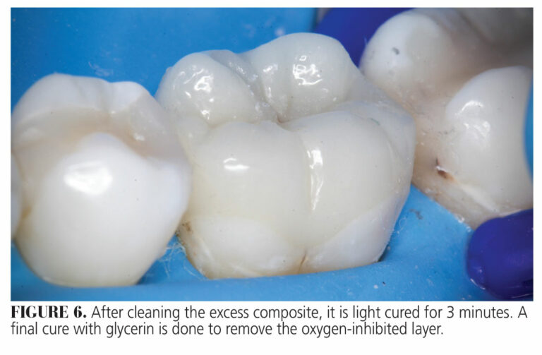 Preserve Natural Teeth With Biomimetic Dentistry - Decisions in Dentistry