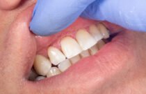 The Concept of Biologic Width in Restorative Dentistry - Decisions in ...
