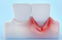 Making the Most of the New Periodontal Classification System ...
