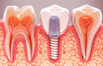 Making the Most of the New Periodontal Classification System ...