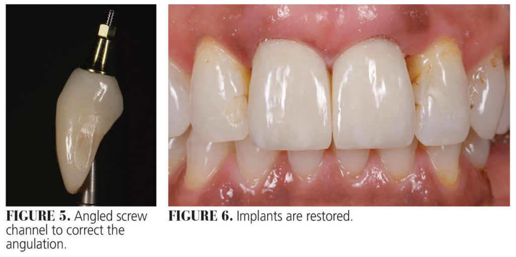Angled Screw-Retained Crowns Advance Esthetics and Function - Decisions ...