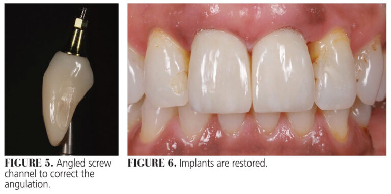 Angled Screw-Retained Crowns Advance Esthetics and Function - Decisions ...